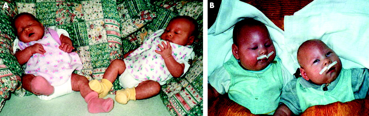 Nijmegen breakage syndrome (NBS) with neurological abnormalities and ...