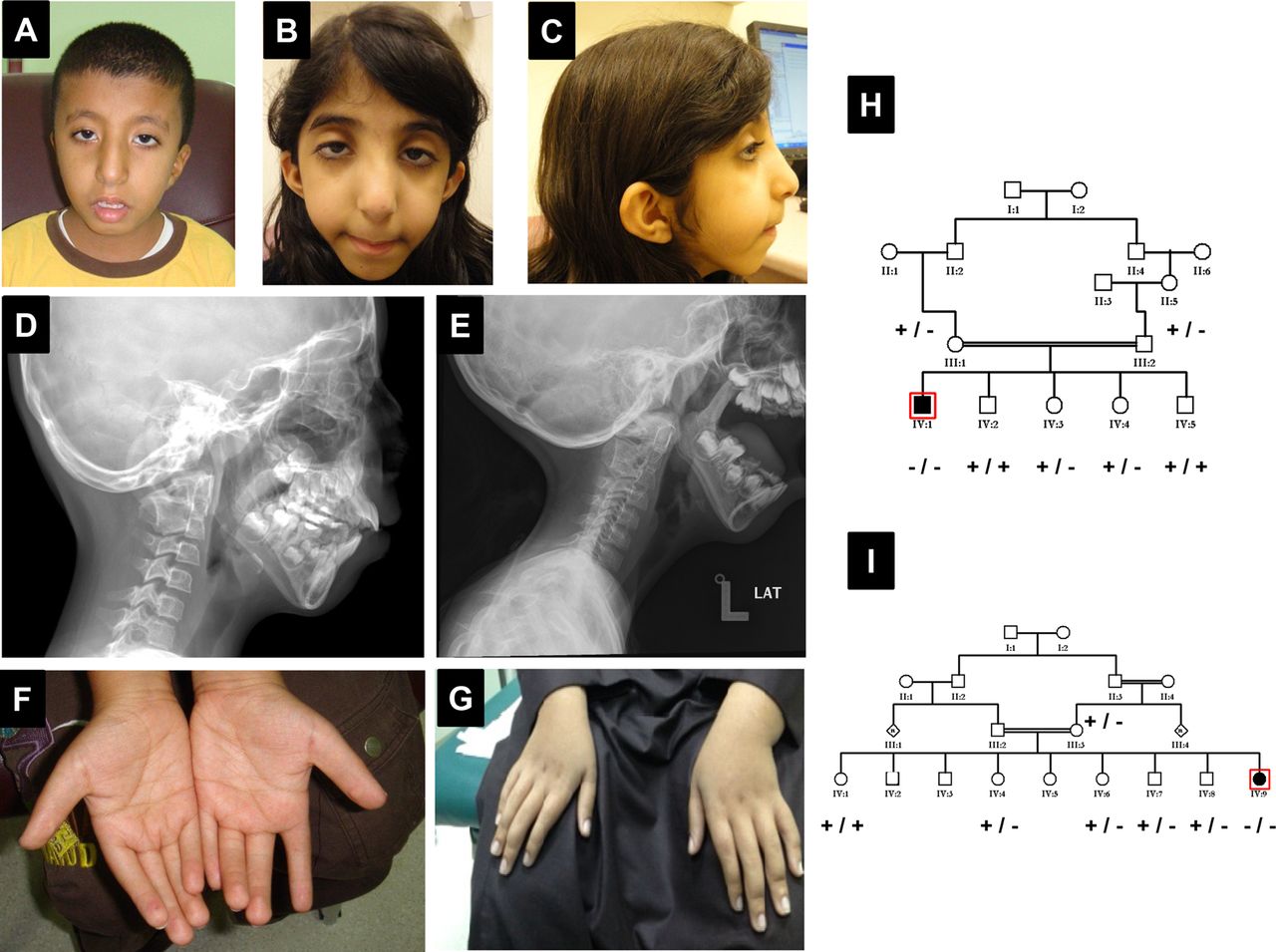 A novel syndrome of Klippel-Feil anomaly, myopathy, and characteristic ...