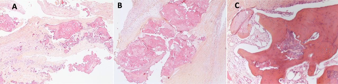 Cardiac valve involvement in ADAR-related type I interferonopathy ...