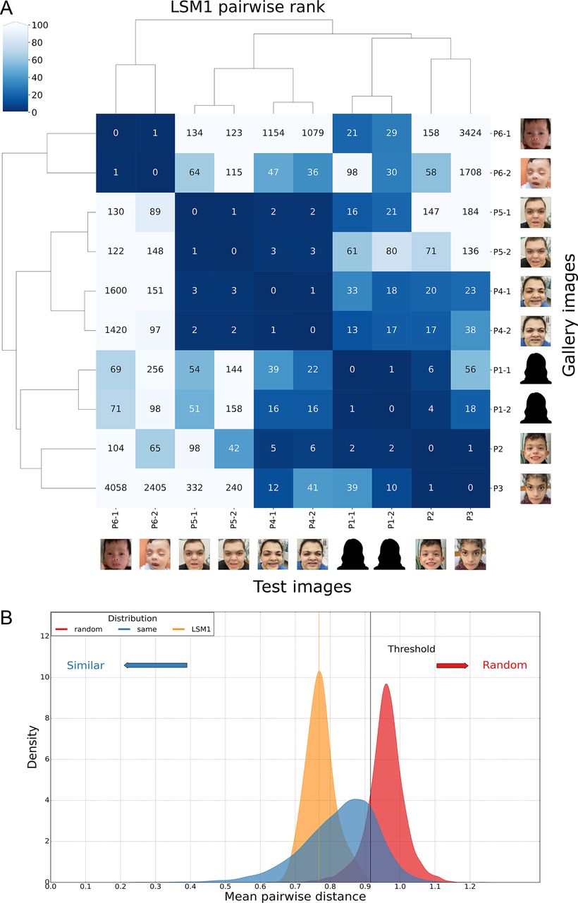 LSM1 c.231+4A>C hotspot variant is associated with a novel ...